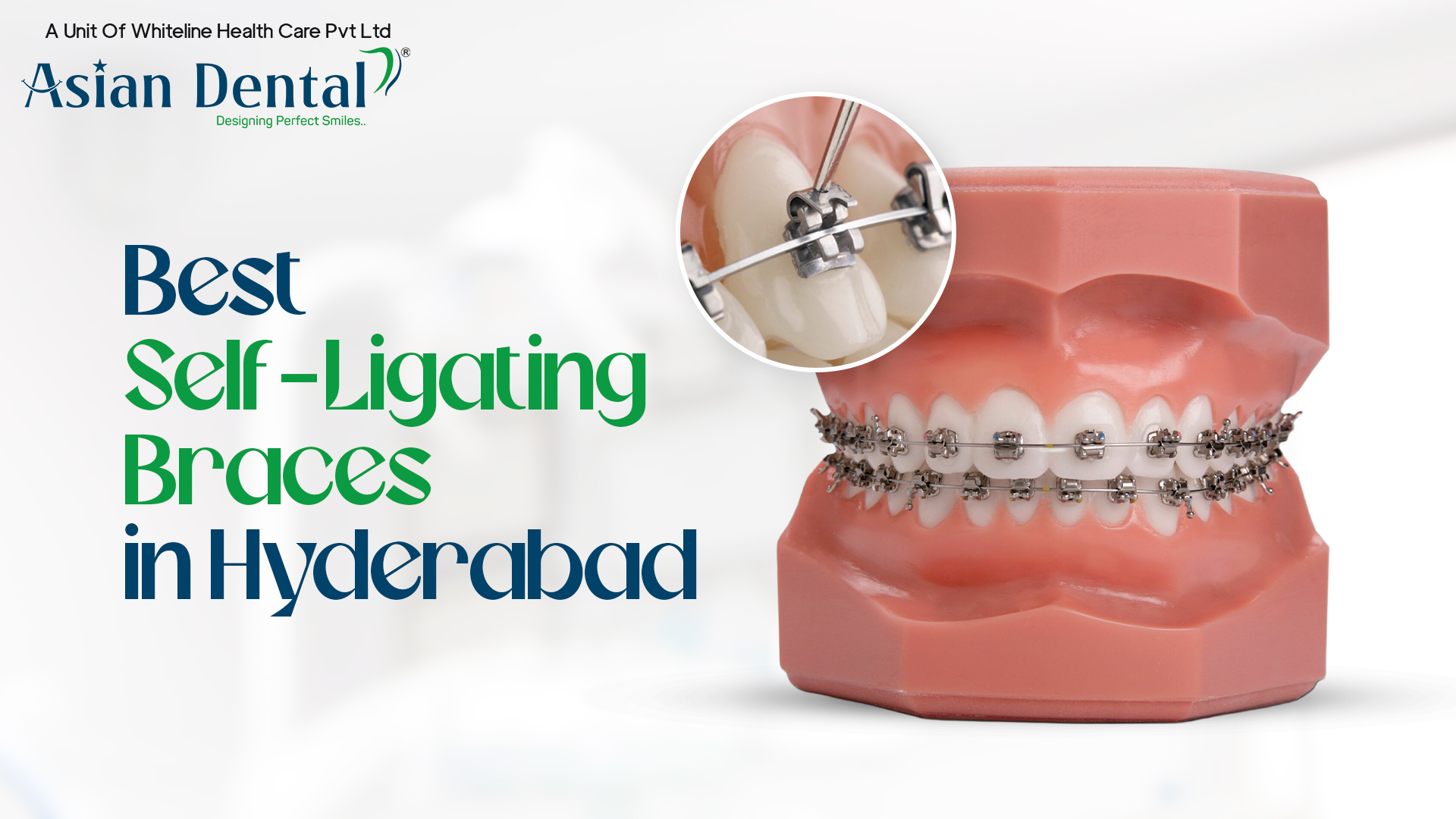 Best Self-Ligating Braces in Hyderabad - Asian Dental