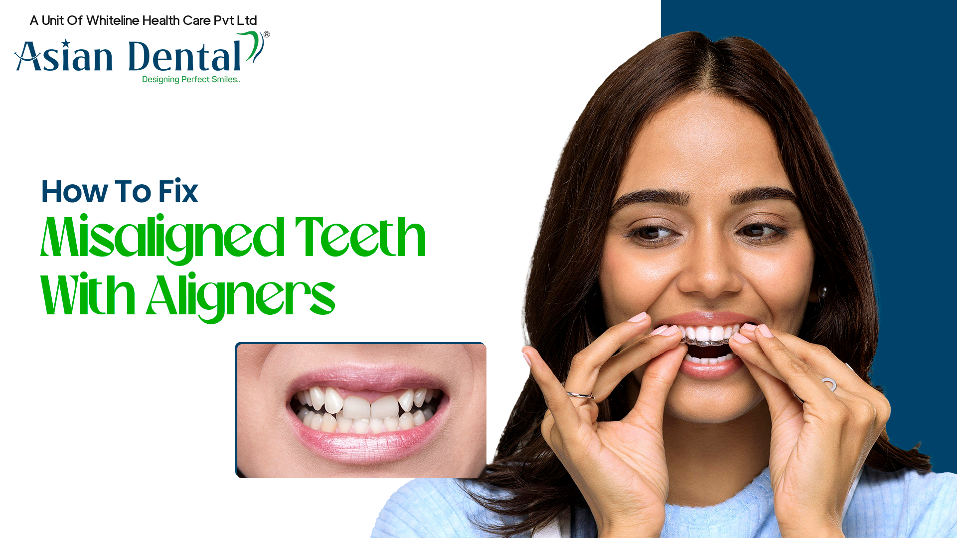 How To Fix Misaligned Teeth with Aligners – Asian Dental